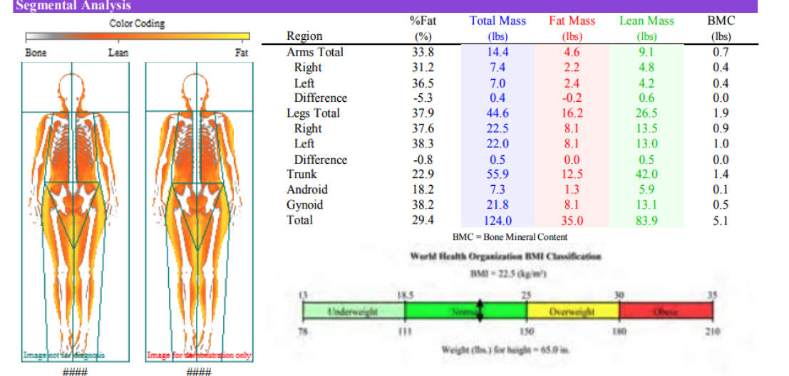 DXA Scan: The Gold Standard of Body Composition